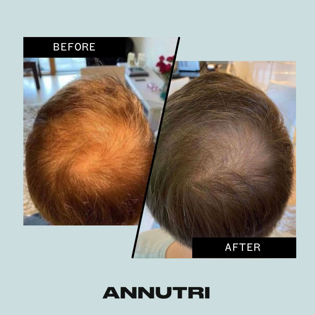 Hair Growth Supplement Reviews & Hair Growth Results – annutri